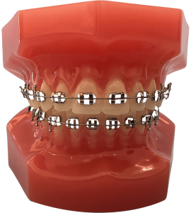 Best Power Chain Colors Picker for Braces | Elate Ortho